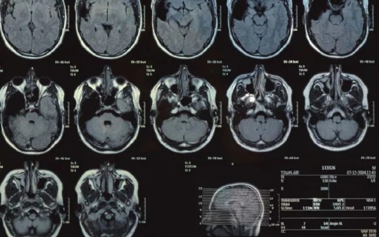 Completing an Ironman with Stage IV Brain Cancer